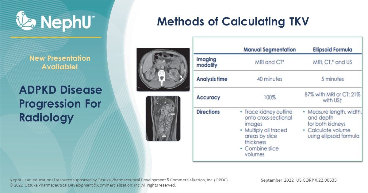 Autosomal Dominant Polycystic Kidney Disease (ADPKD): Disease ...